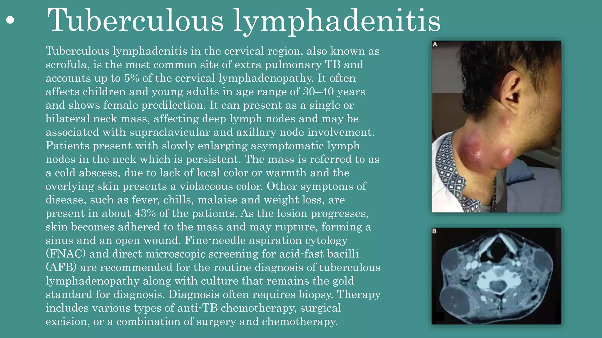 Tuberculosis of the oral cavity and facial bones (orofacial ...