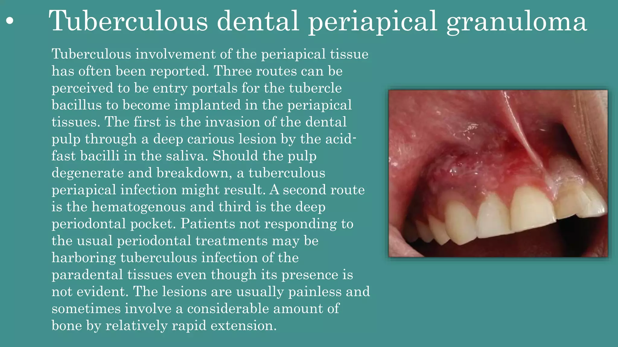 Tuberculosis of the oral cavity and facial bones (orofacial ...