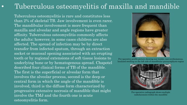 Tuberculosis of the oral cavity and facial bones (orofacial ...