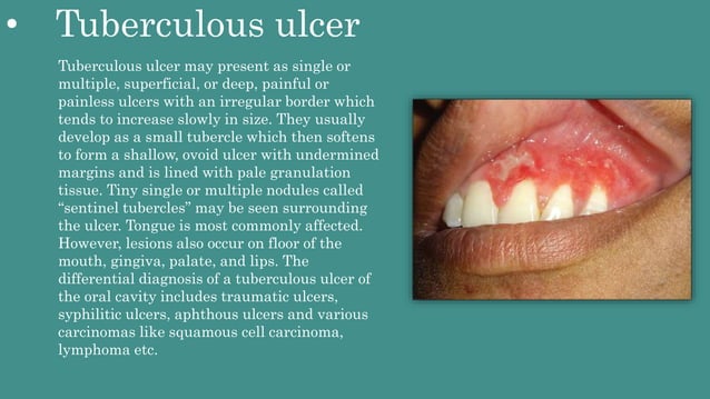 Tuberculosis of the oral cavity and facial bones (orofacial ...
