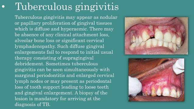 Tuberculosis of the oral cavity and facial bones (orofacial ...