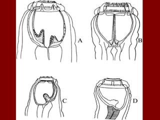 Strongylus Edentatus