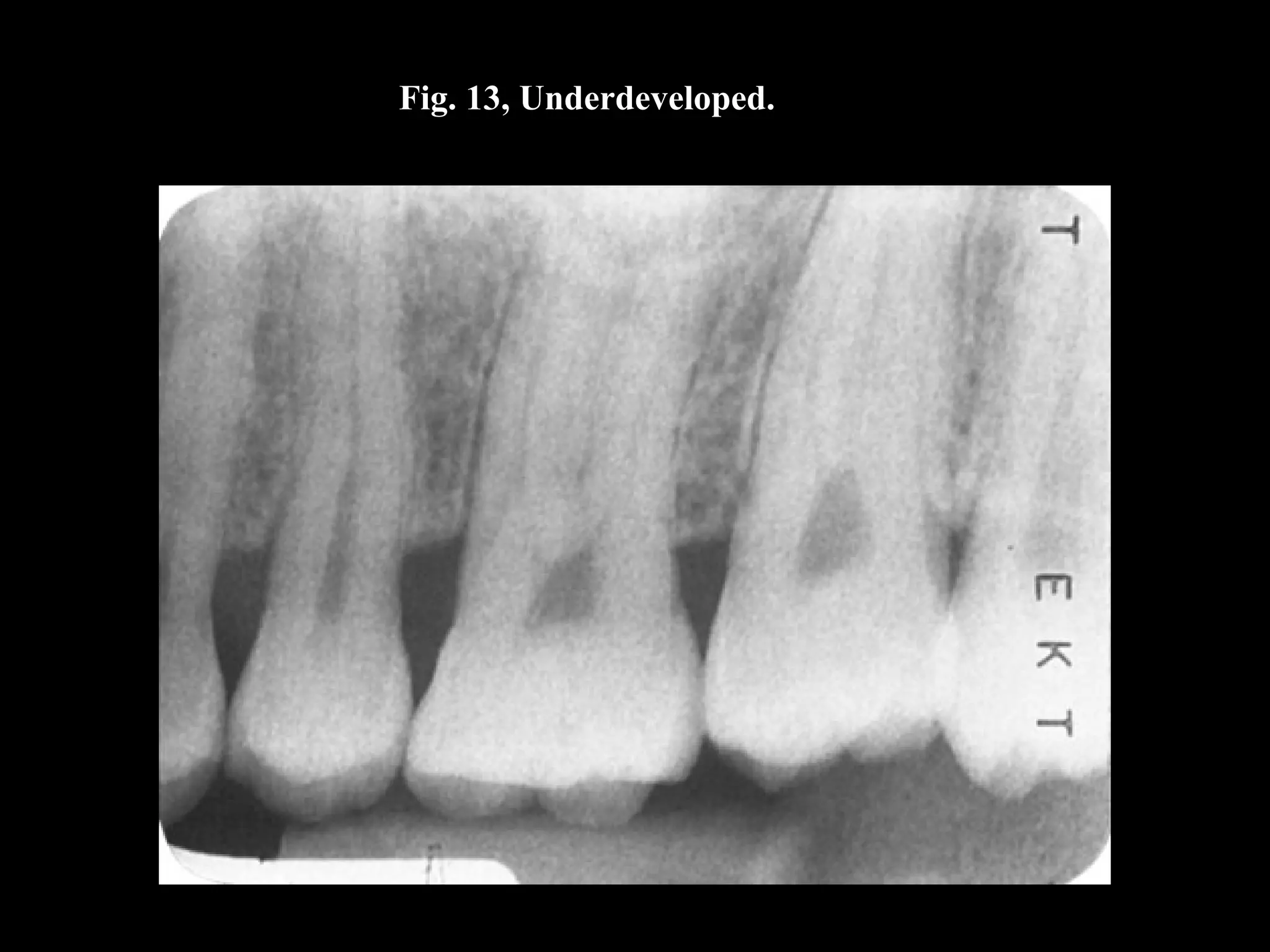 Lecture 7 dental x ray film, processing and processing errors lecture 7 ...