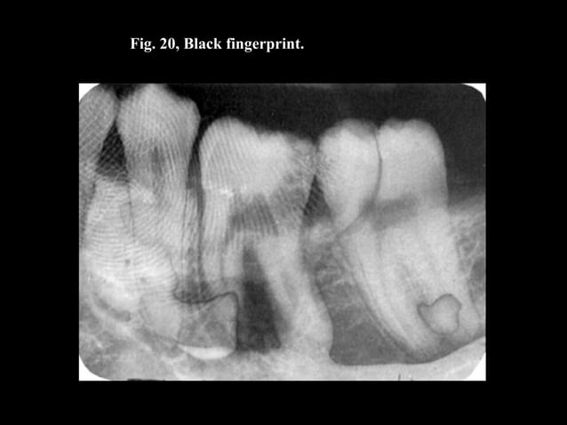Lecture 7 dental x ray film, processing and processing errors lecture 7 ...
