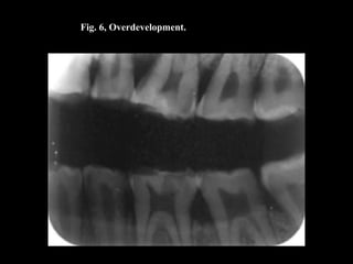 Lecture 7 dental x ray film, processing and processing errors lecture 7 ...