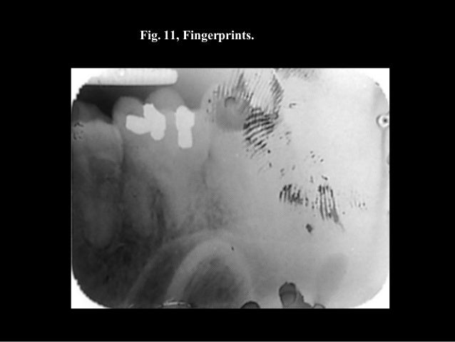 Lecture 7 dental x ray film, processing and processing errors lecture…