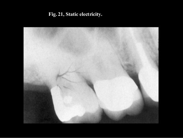 Lecture 7 dental x ray film, processing and processing errors lecture…
