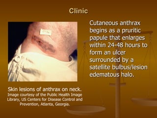 Lecture 8. anthrex, plague | PPT