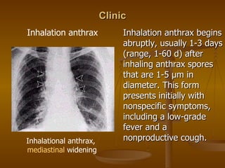 Anthrax Disease Inhalation