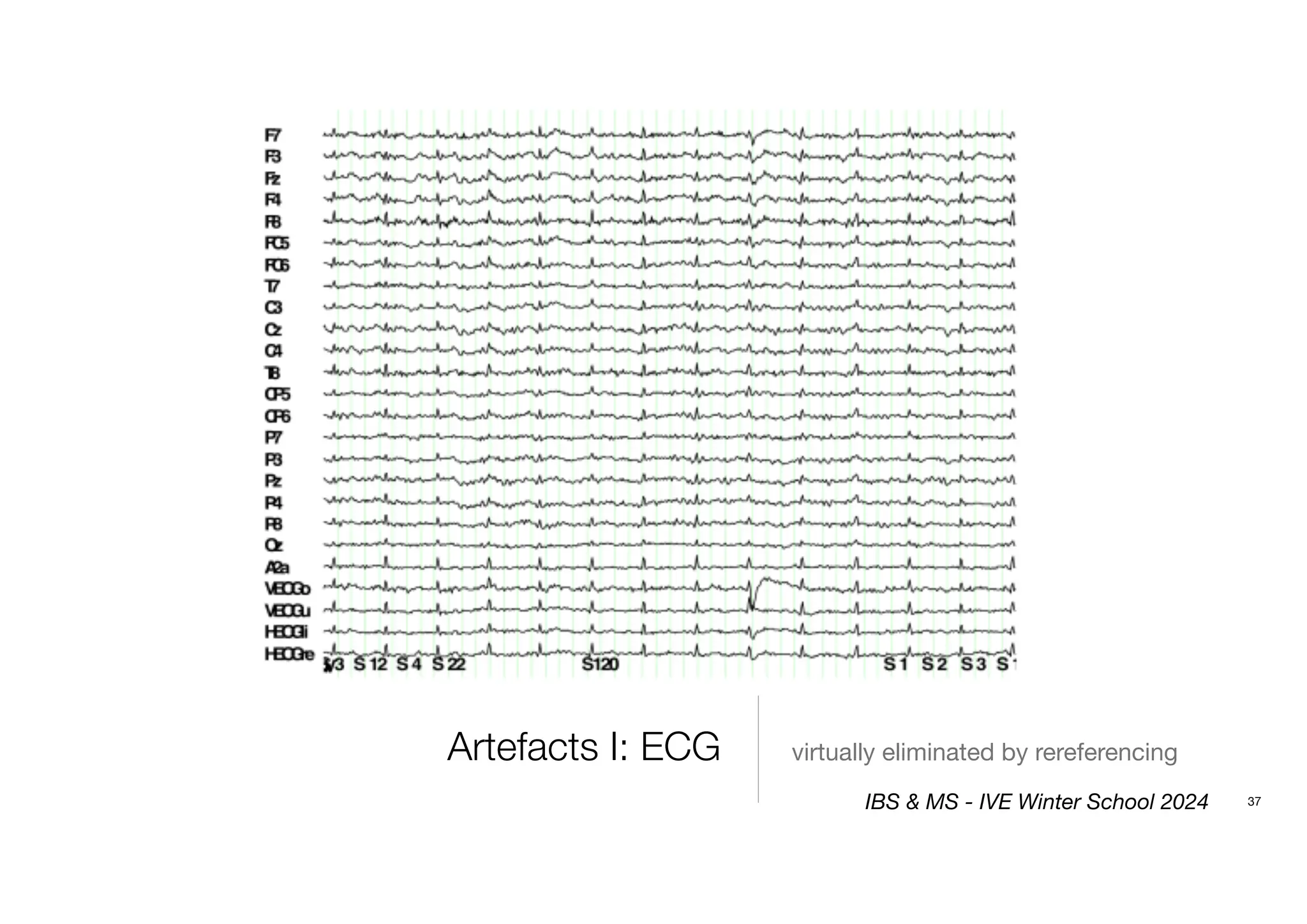 IVE 2024 Short Course - Lecture 8 - Electroencephalography (EEG) Basics | PPT