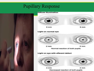 LECTURE 8 Eye Assessment.pdf Assessing the eye | PDF