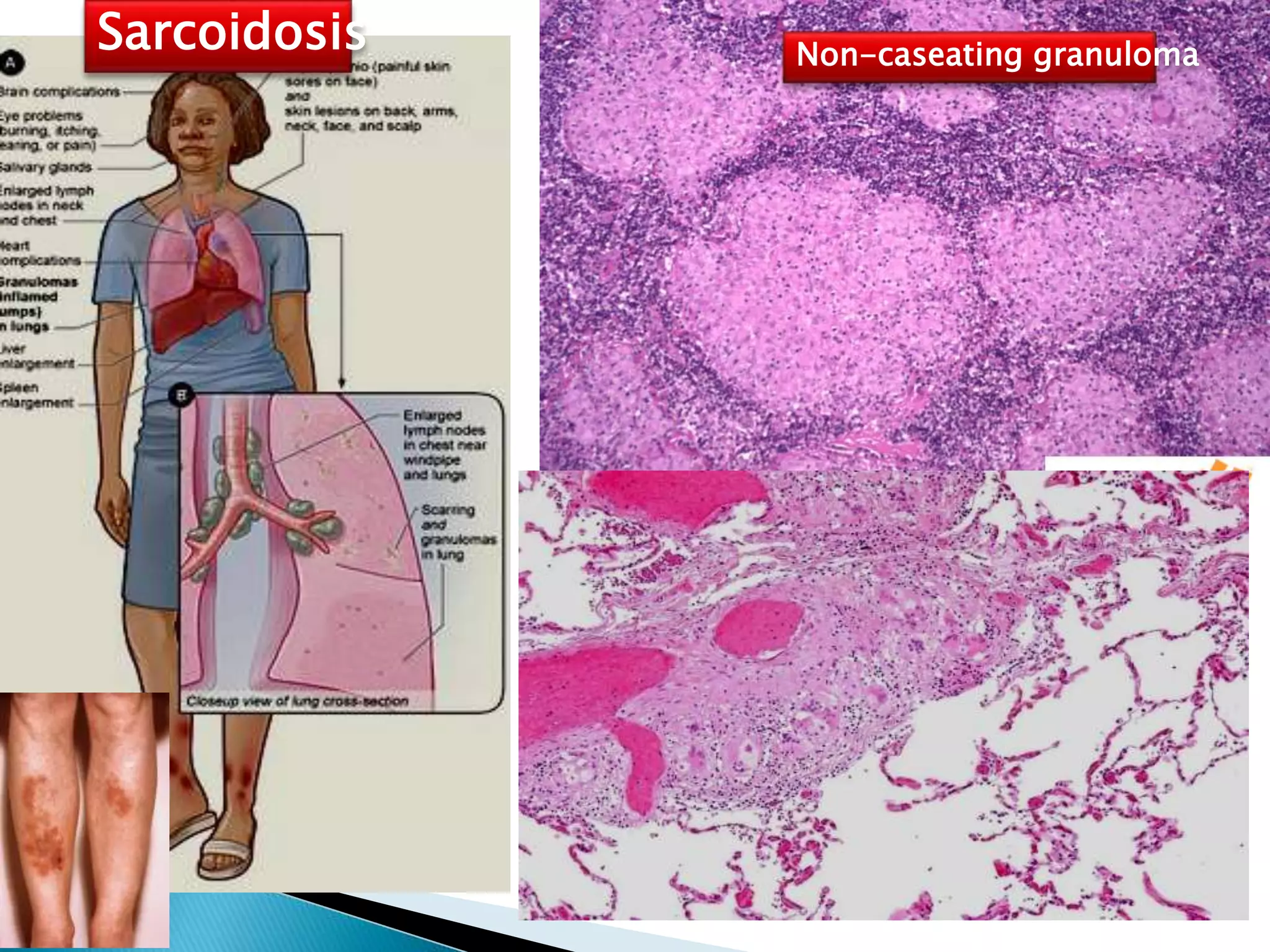 lecture 9-GRANULOMATOUS INFLAMMATION .ppt