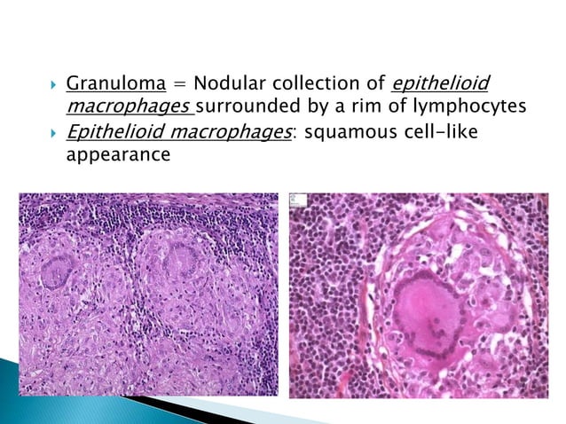 lecture 9-GRANULOMATOUS INFLAMMATION .ppt