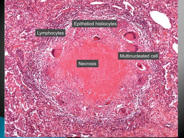 lecture 9-GRANULOMATOUS INFLAMMATION .ppt lecture 9-GRANULOMATOUS INFLAMMATION .ppt