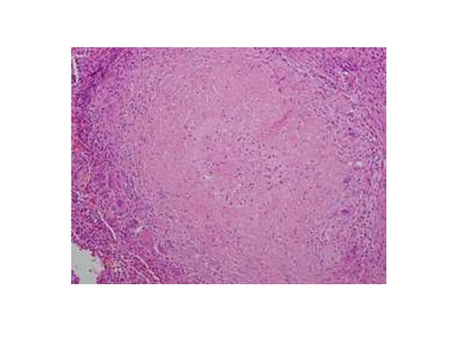 lecture 9-GRANULOMATOUS INFLAMMATION .ppt lecture 9-GRANULOMATOUS INFLAMMATION .ppt