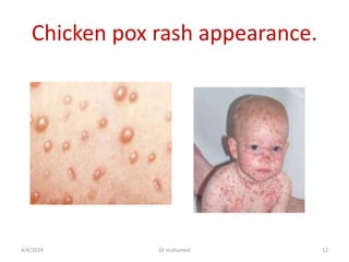 Lecture 9 Paediatric viral infections 1.-1.pptx