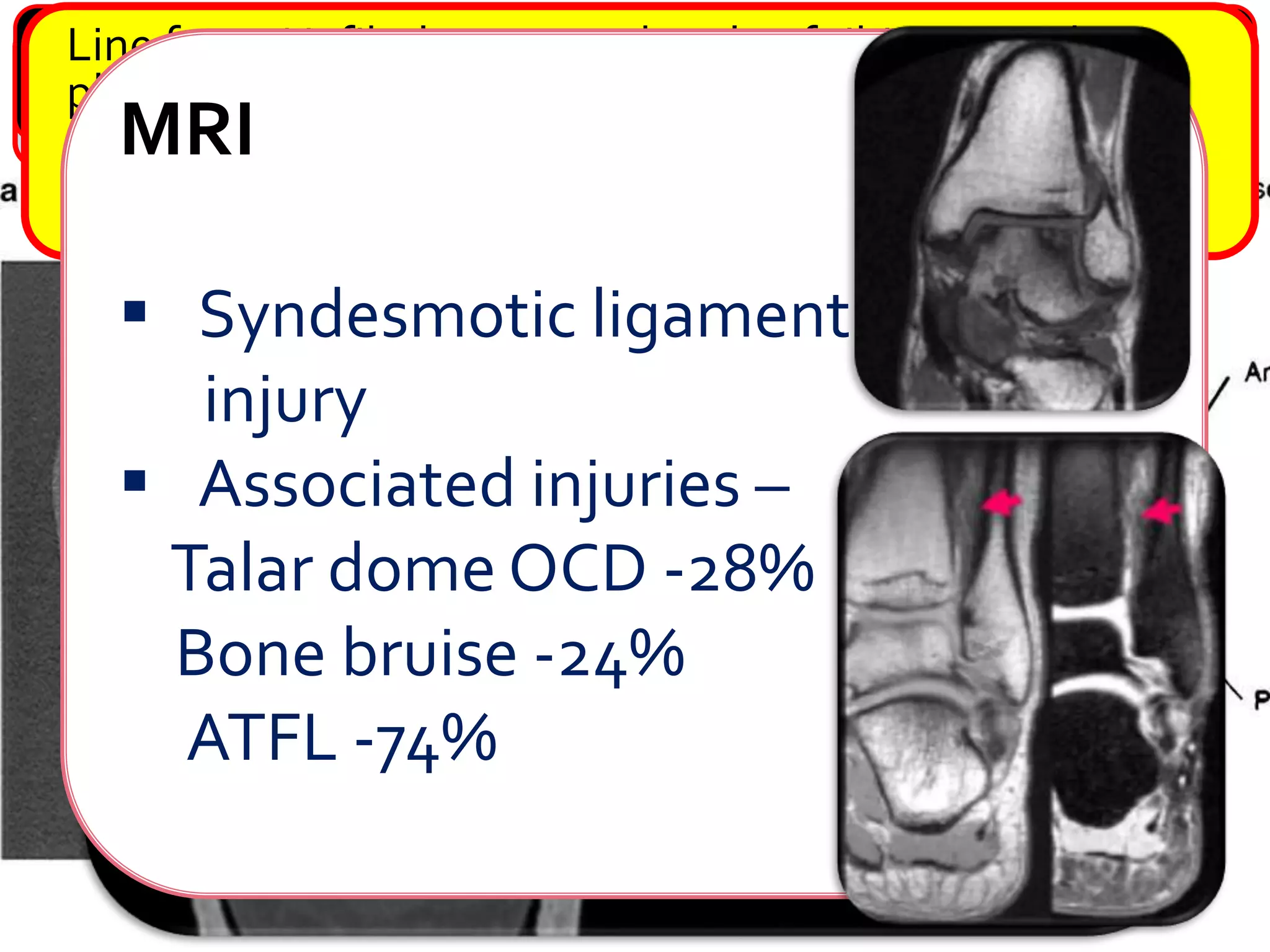 Lecture 9 shah ankle fractures | PPTX