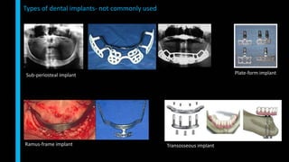 Lecture BDS IV Implant Dentistry | PPTX | Dental Health | Diseases and ...