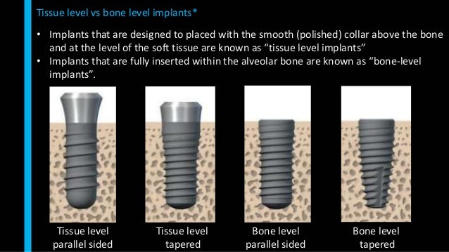 Implant Bone Level Tissue Level – MGNAR