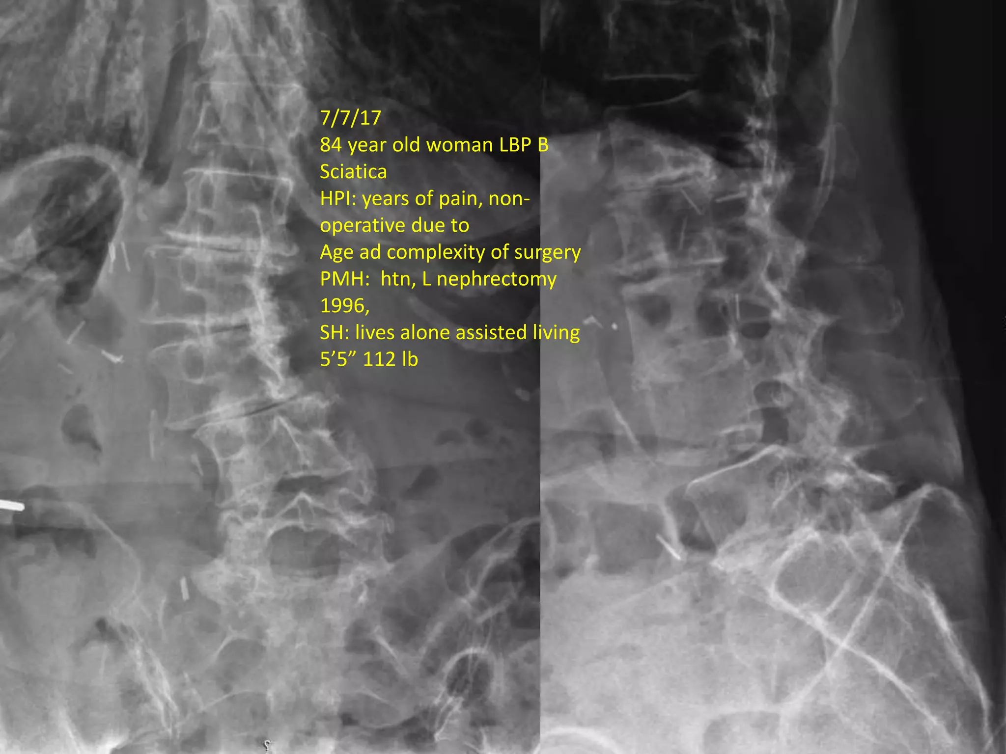 BMP bone morphogenic protein in spinal surgery | PPT