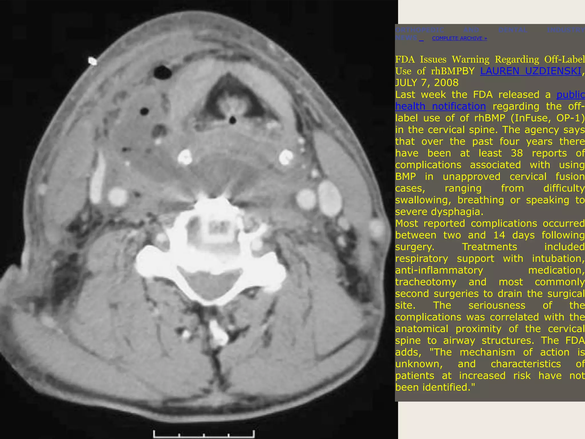 BMP bone morphogenic protein in spinal surgery | PPT