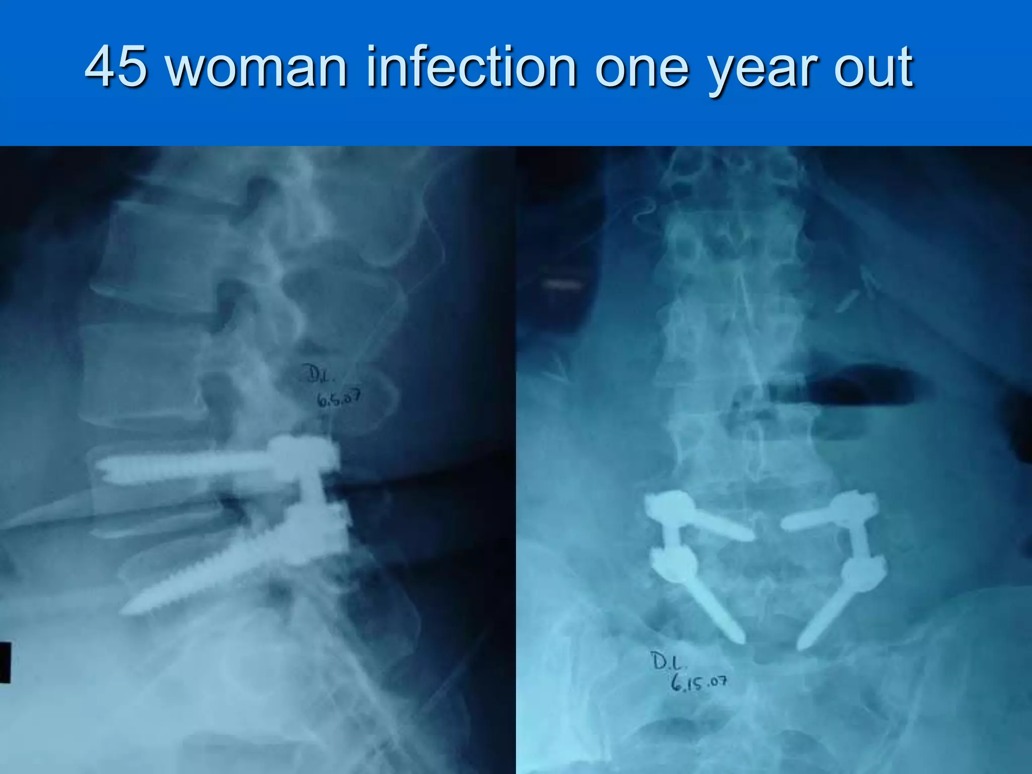 BMP bone morphogenic protein in spinal surgery | PPT