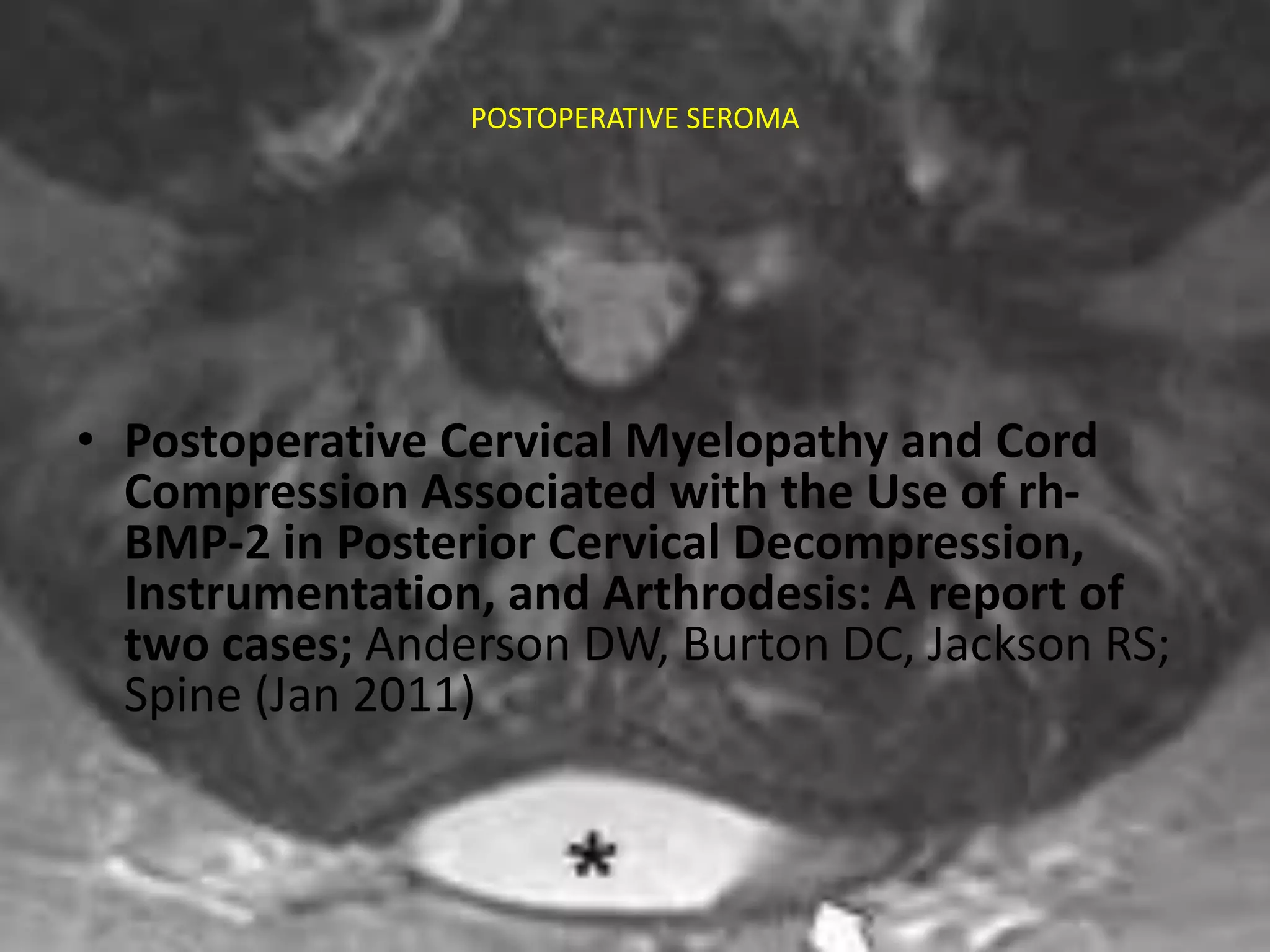 BMP bone morphogenic protein in spinal surgery | PPT | Free Download