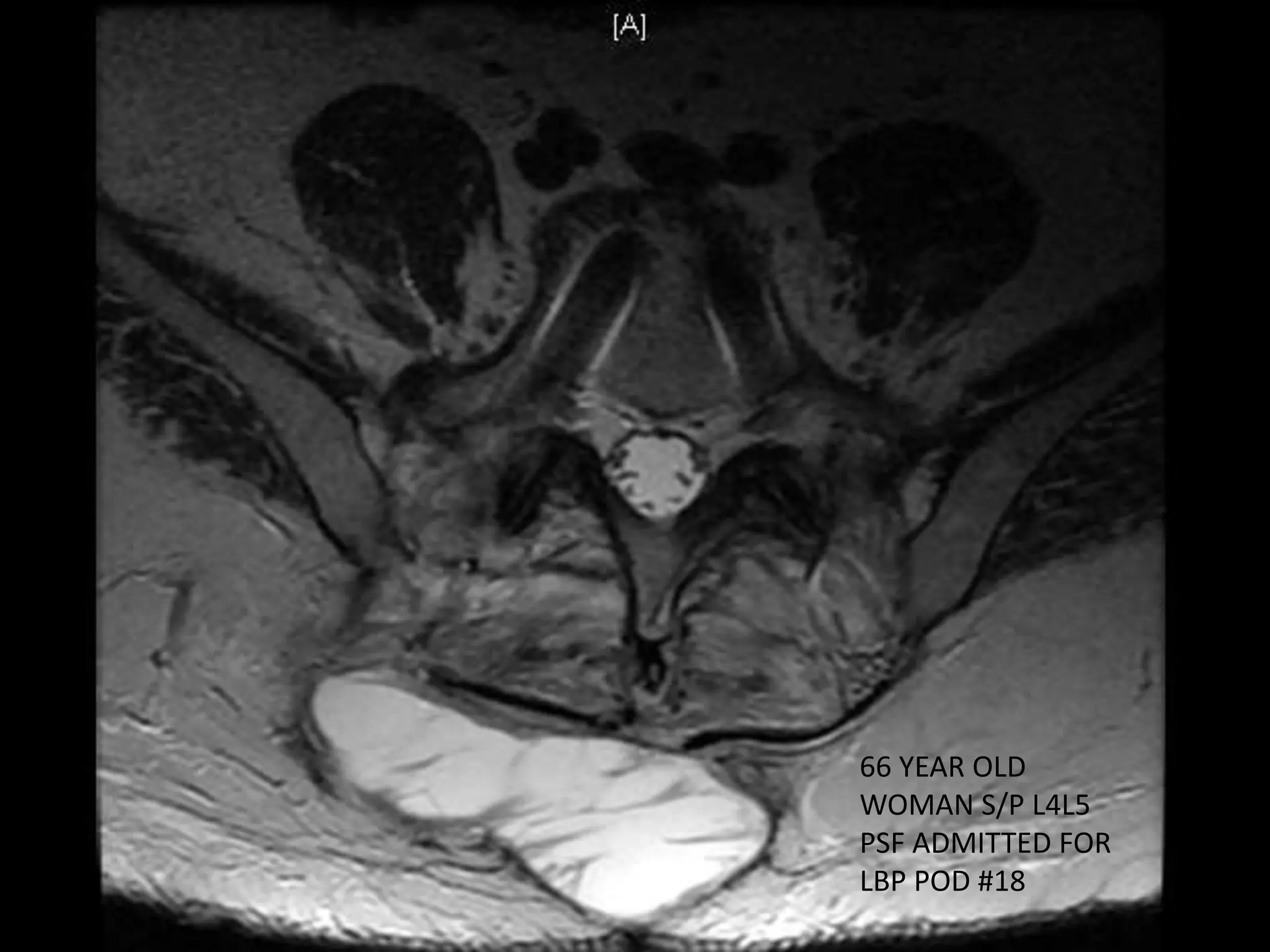 BMP bone morphogenic protein in spinal surgery | PPT