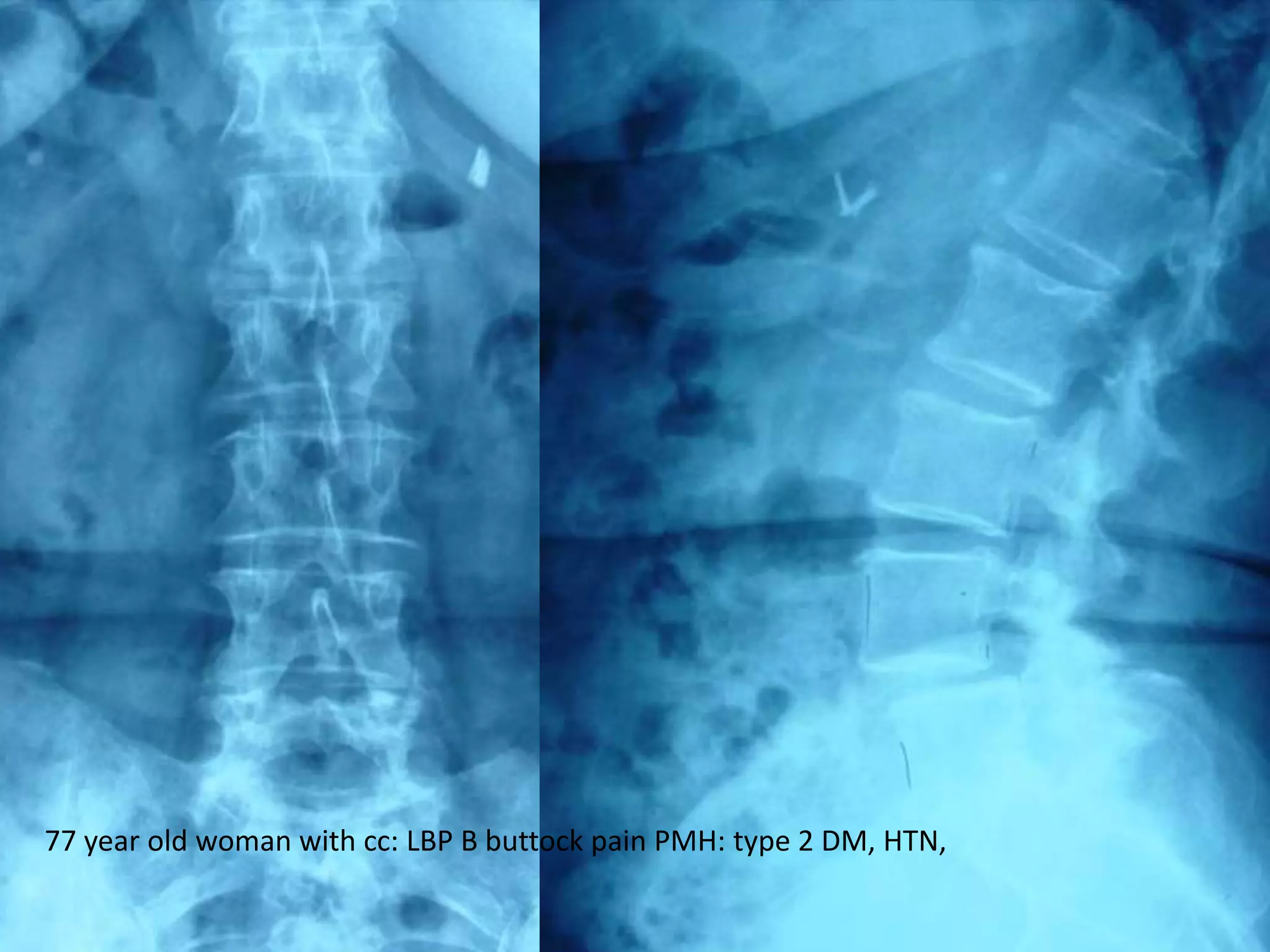 BMP bone morphogenic protein in spinal surgery | PPT | Free Download
