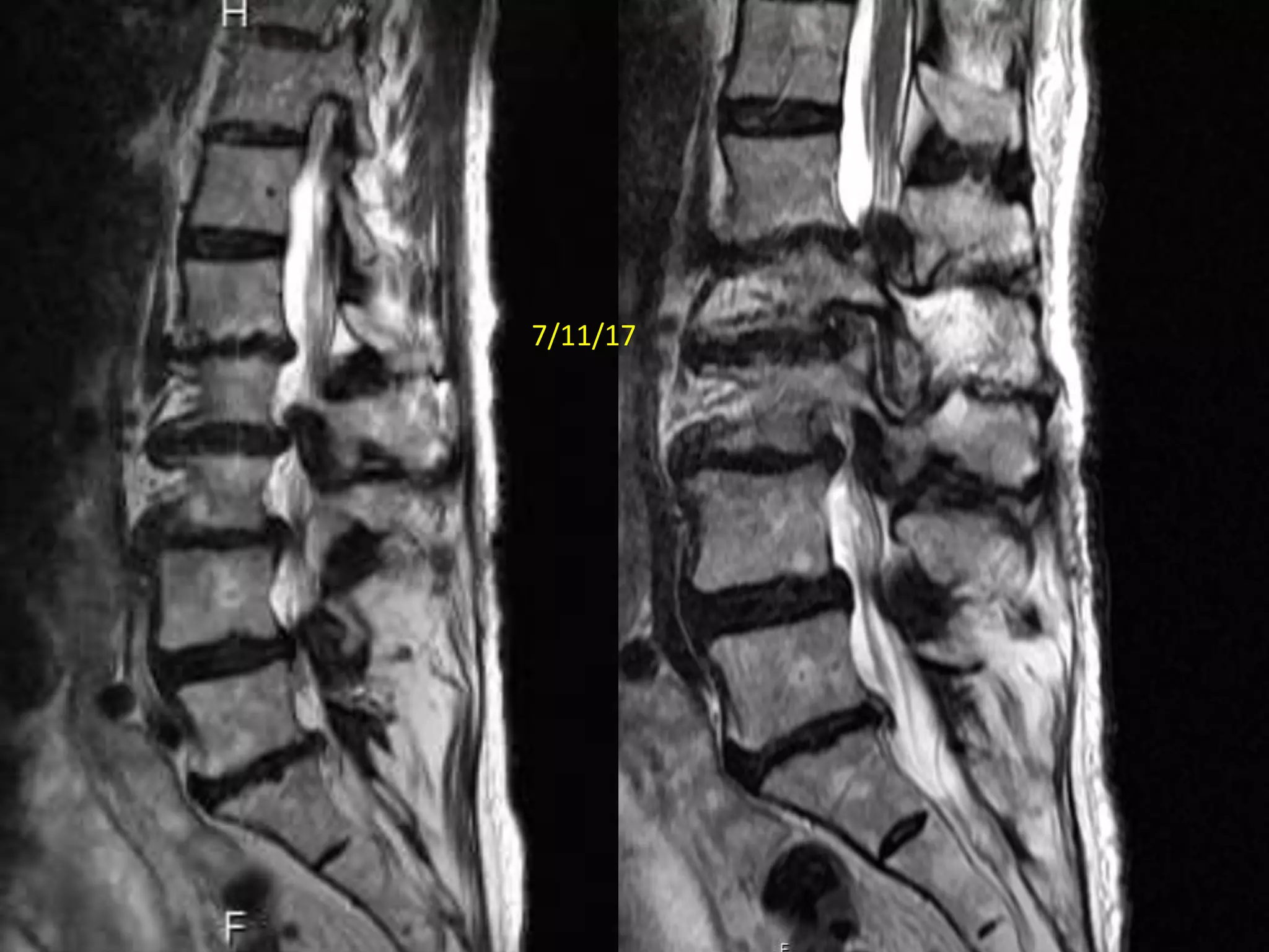 BMP bone morphogenic protein in spinal surgery | PPT