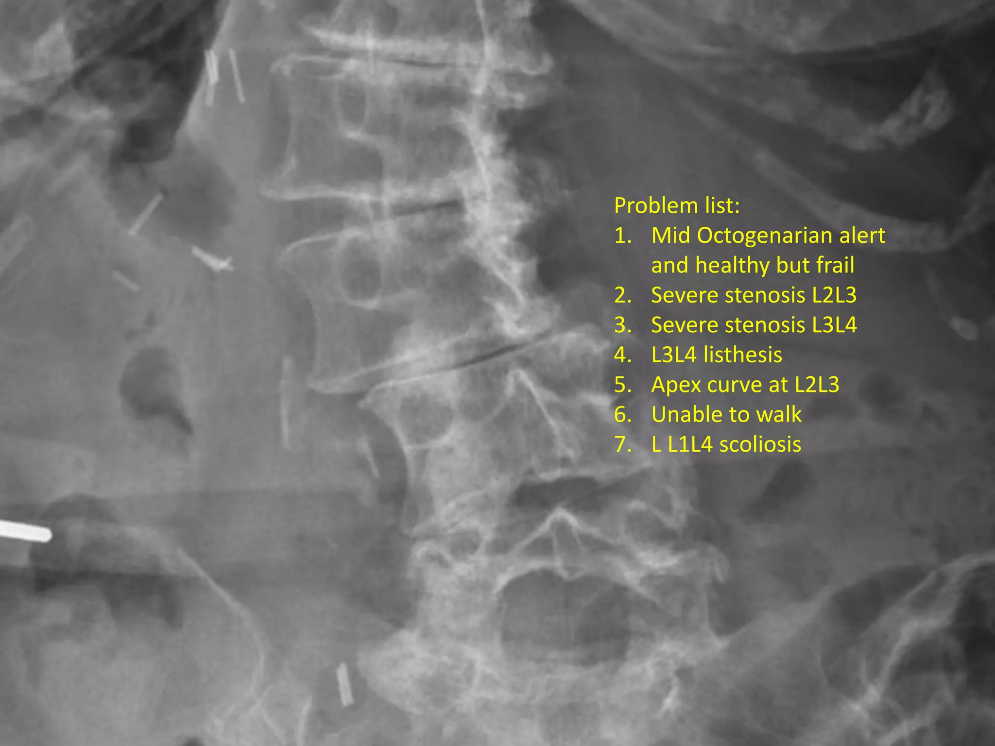 BMP bone morphogenic protein in spinal surgery | PPT | Free Download