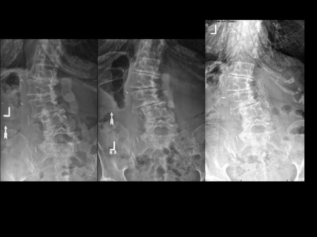 BMP bone morphogenic protein in spinal surgery | PPT