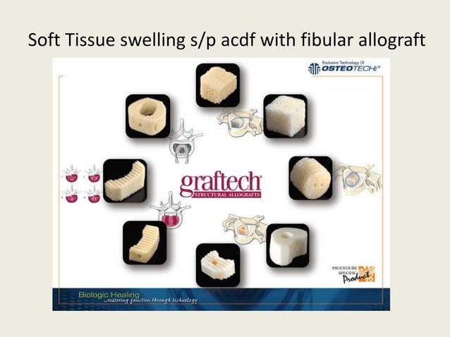 BMP bone morphogenic protein in spinal surgery | PPT