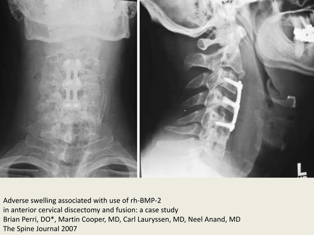 BMP bone morphogenic protein in spinal surgery | PPT