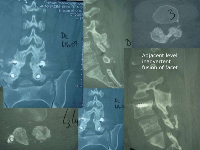 BMP bone morphogenic protein in spinal surgery | PPT | Free Download