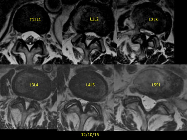 BMP bone morphogenic protein in spinal surgery | PPT