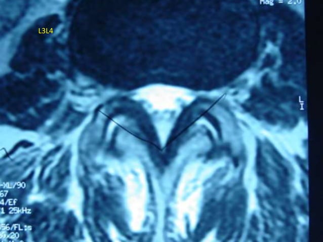BMP bone morphogenic protein in spinal surgery | PPT