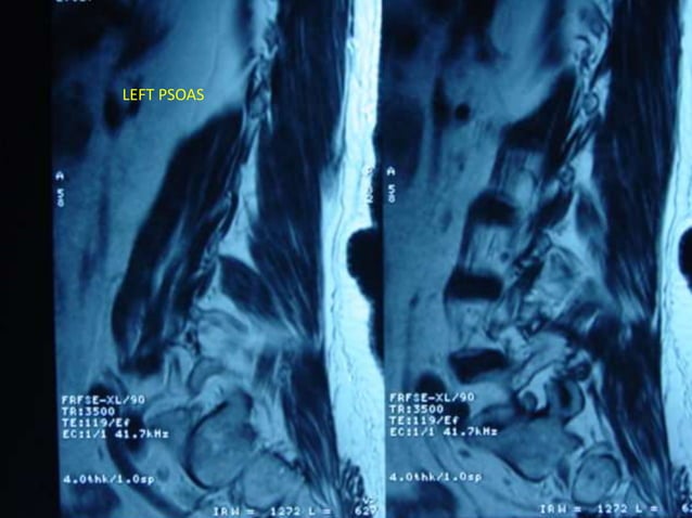 BMP bone morphogenic protein in spinal surgery | PPT