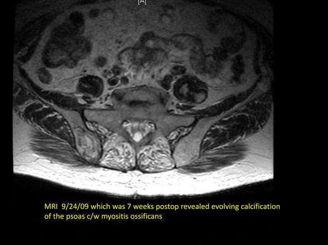 BMP bone morphogenic protein in spinal surgery | PPT
