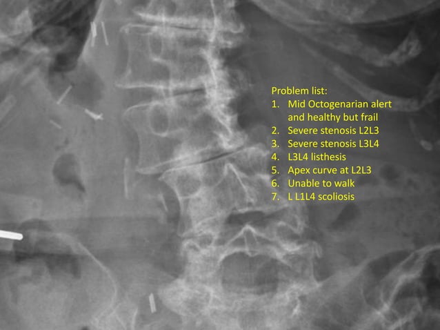 BMP bone morphogenic protein in spinal surgery | PPT