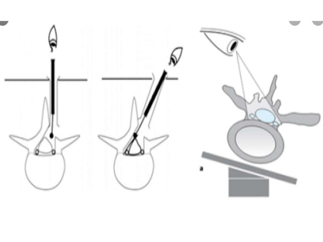BMP bone morphogenic protein in spinal surgery | PPT