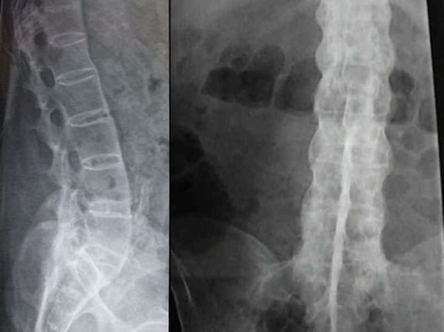 Spine Conference: Cervicothoracic stenosis in a patient with DISH | PPT