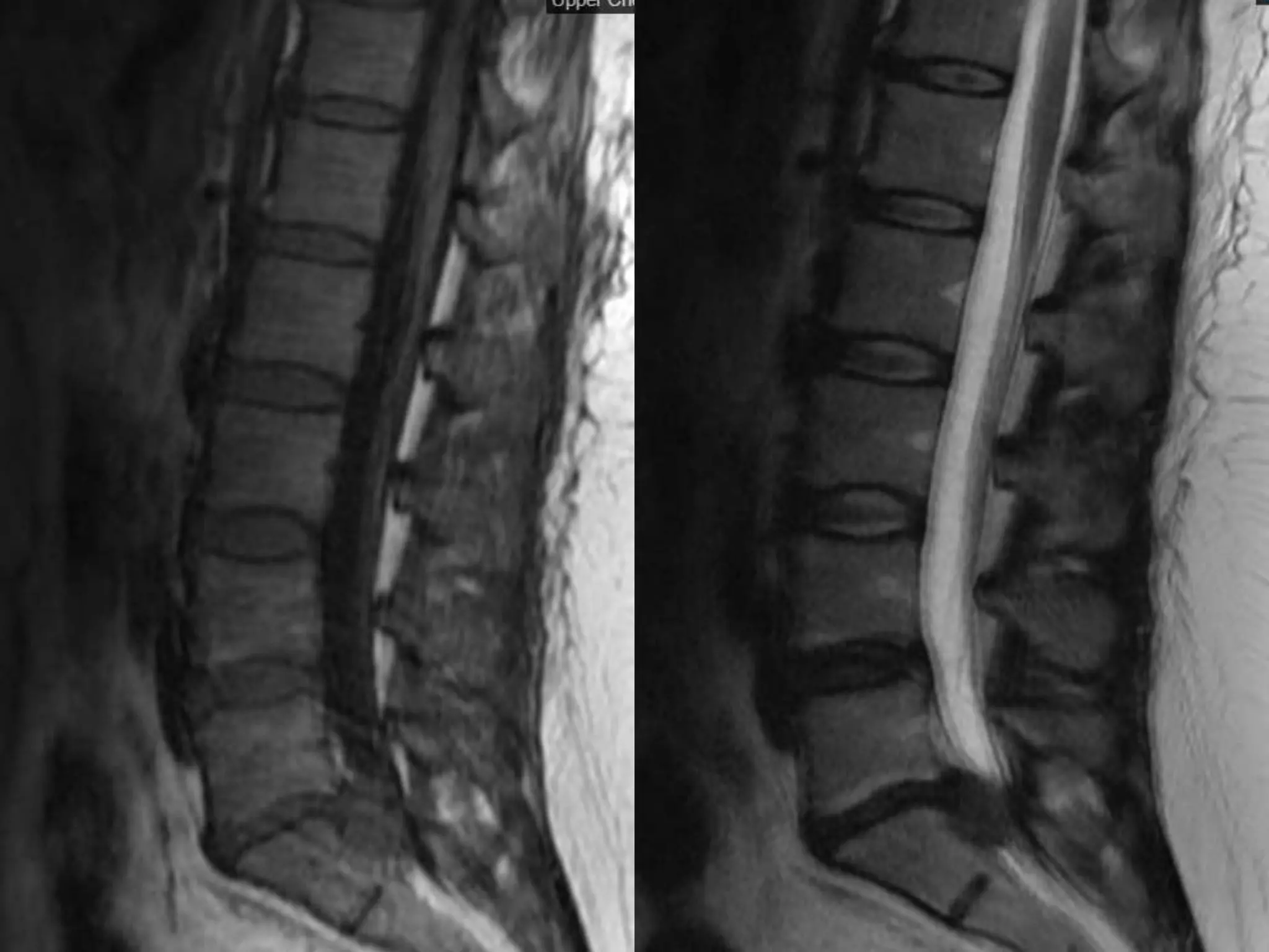 Spine Lecture cauda equina syndrome 2019 sept | PPT