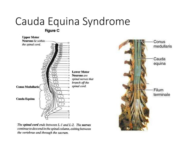 Spine Conference: cauda equina tandem stenosis jan 2021 | PPT