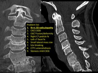 Spine conference: C7T1 spondylolisthesis | PPT