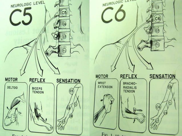 spine lecture cervical radiculopathy | PPT