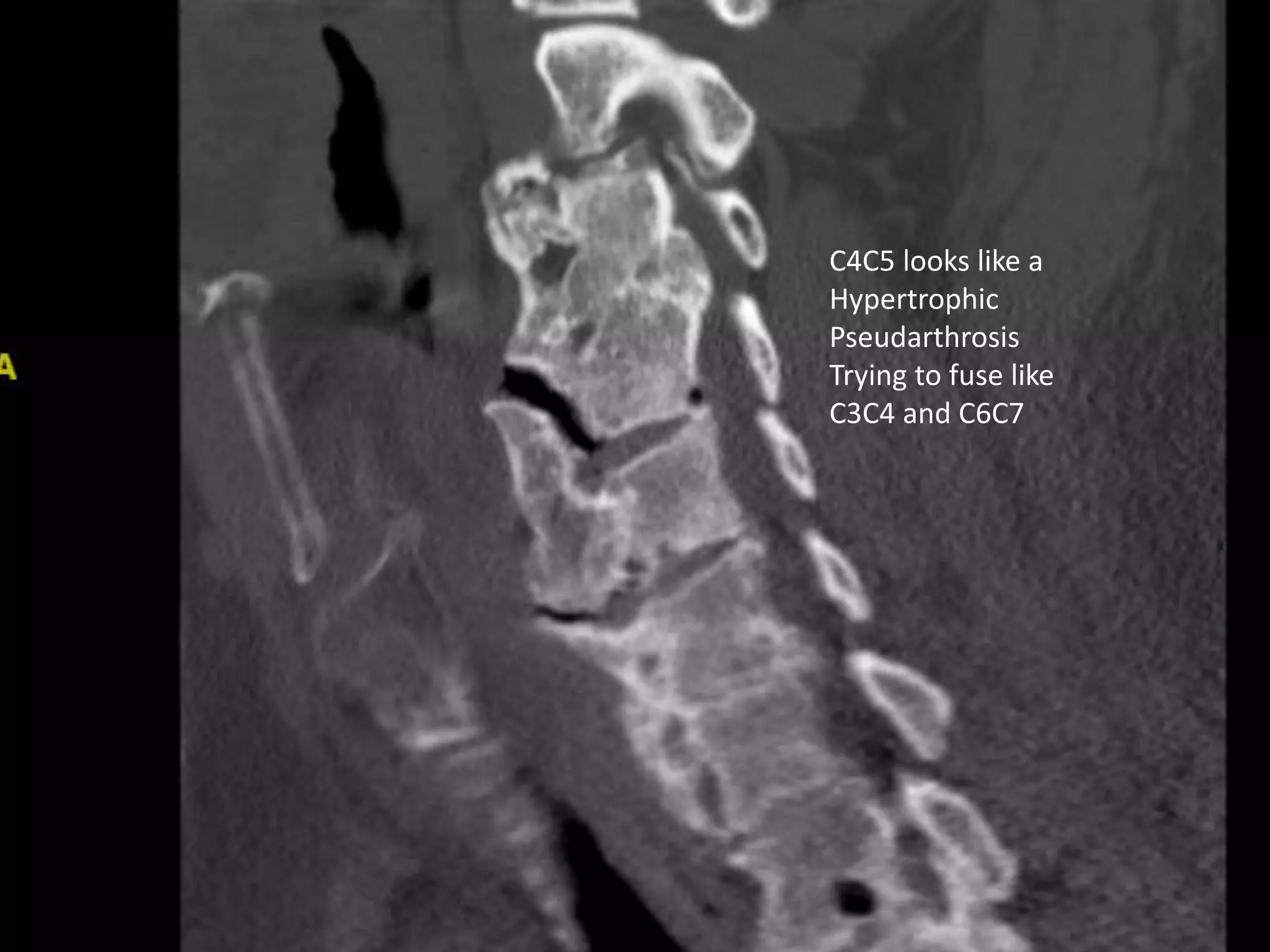 Lecture cervical stenosis DISH diffuse idiopathic skeletal hyperostosis ...