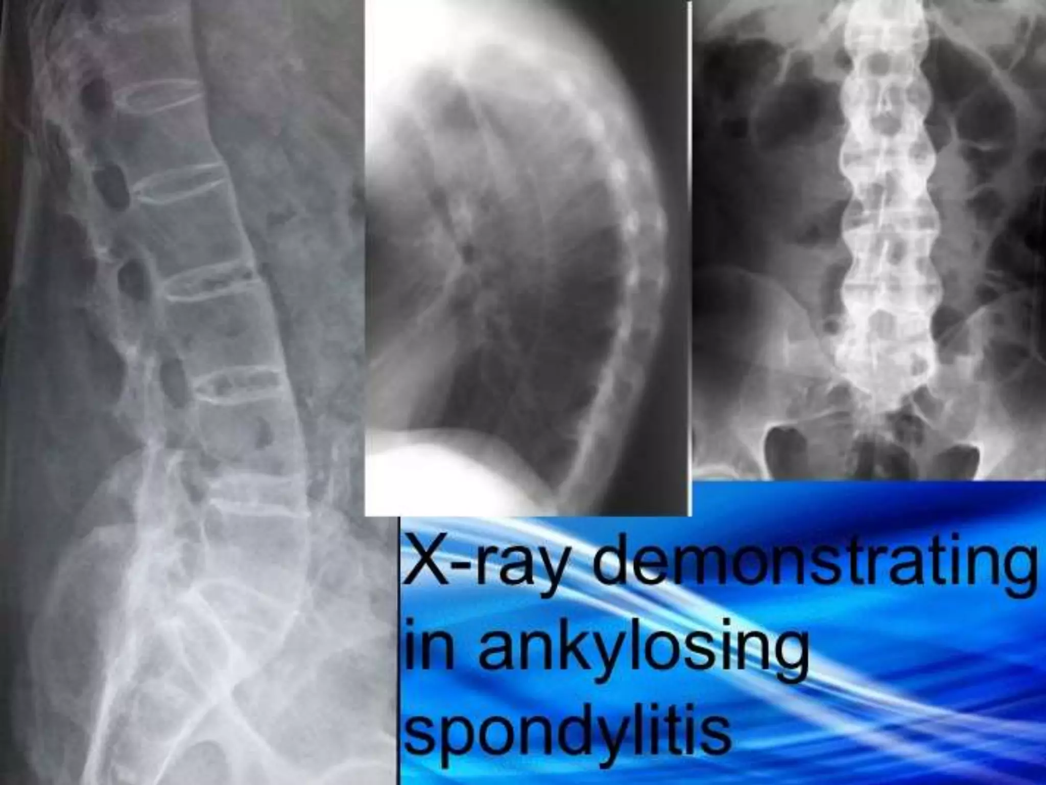 Lecture cervical stenosis DISH diffuse idiopathic skeletal hyperostosis ...