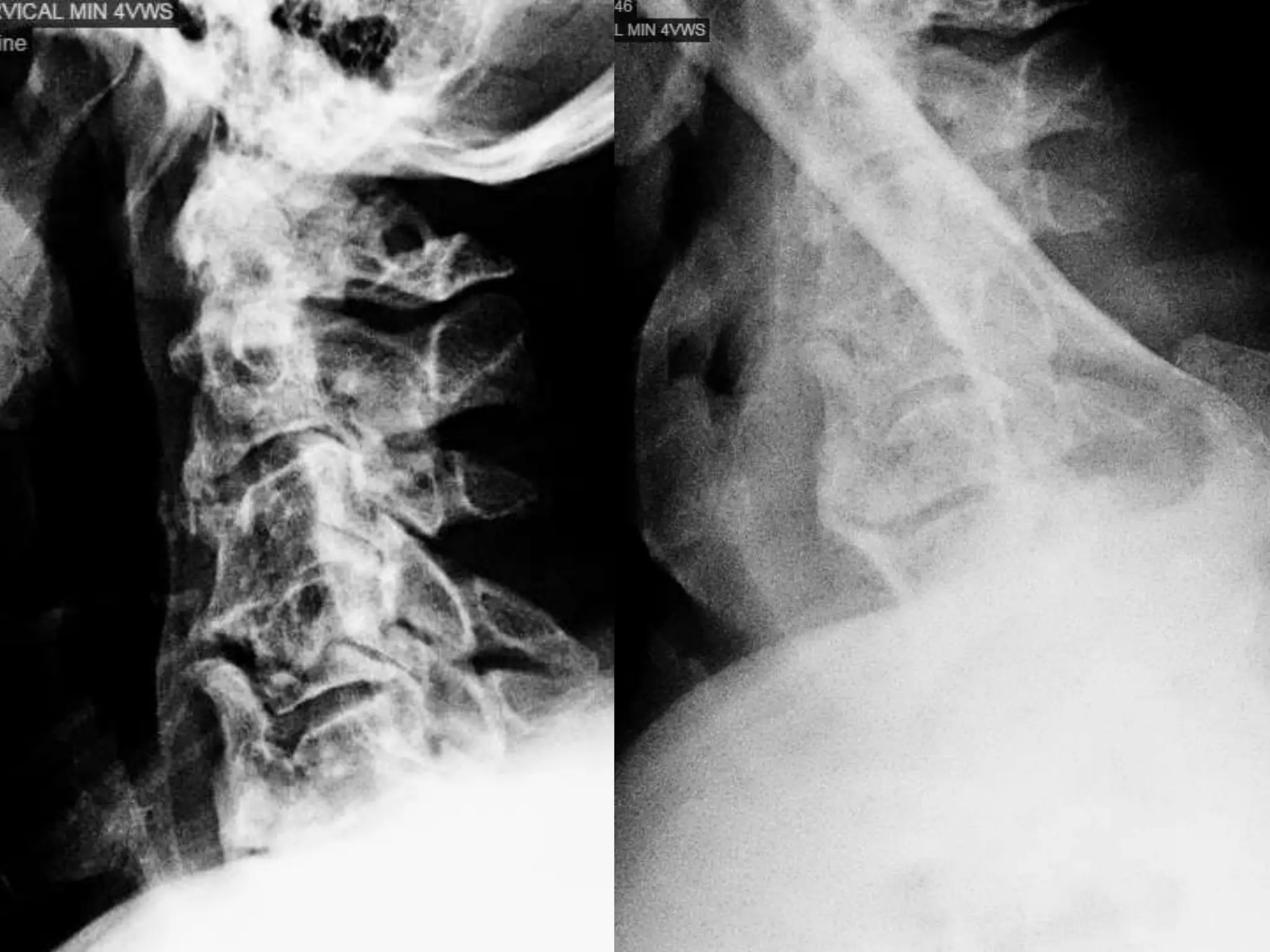 Lecture cervical stenosis DISH diffuse idiopathic skeletal hyperostosis ...