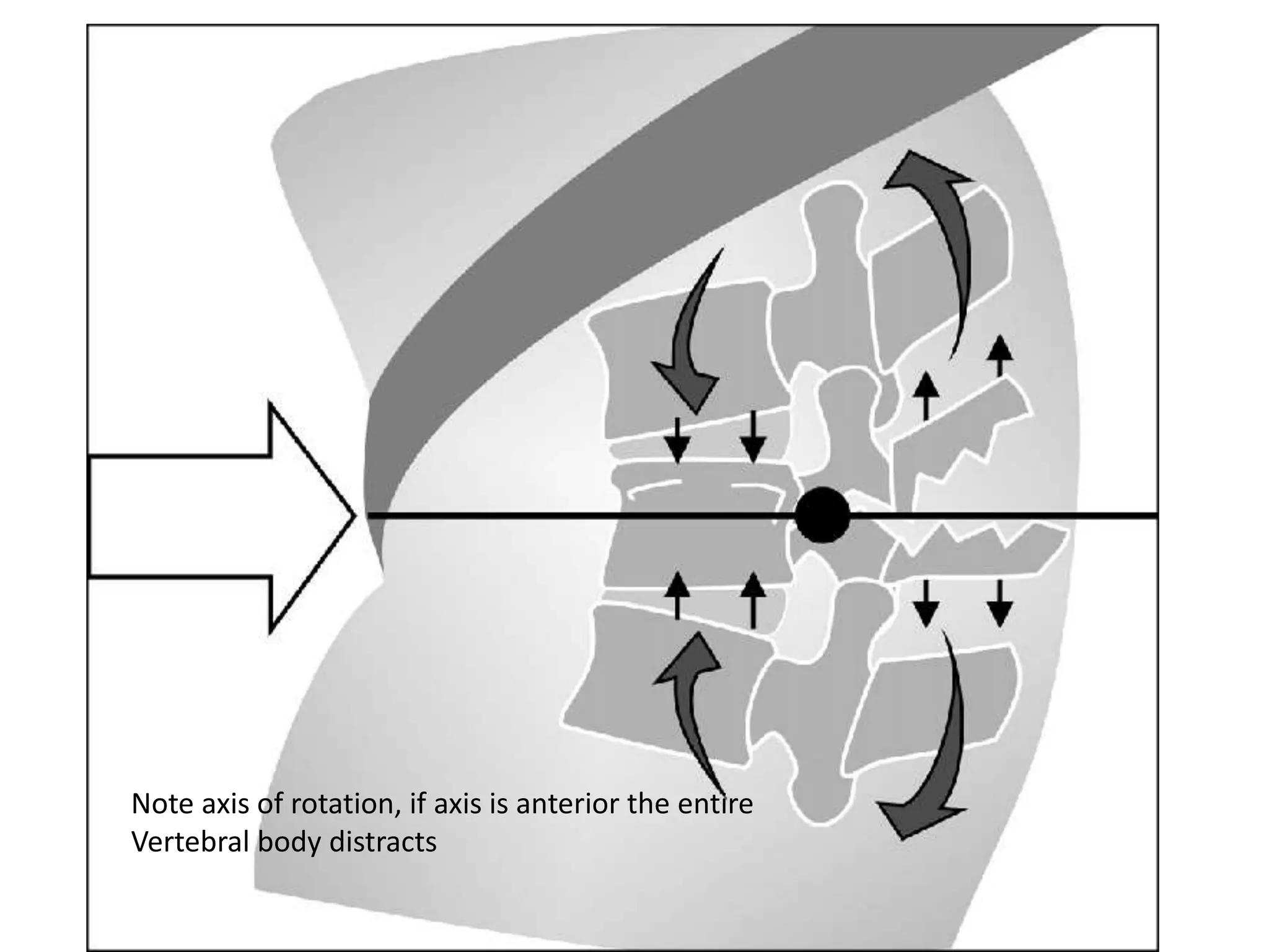 chance fractures of the spine | PPTX